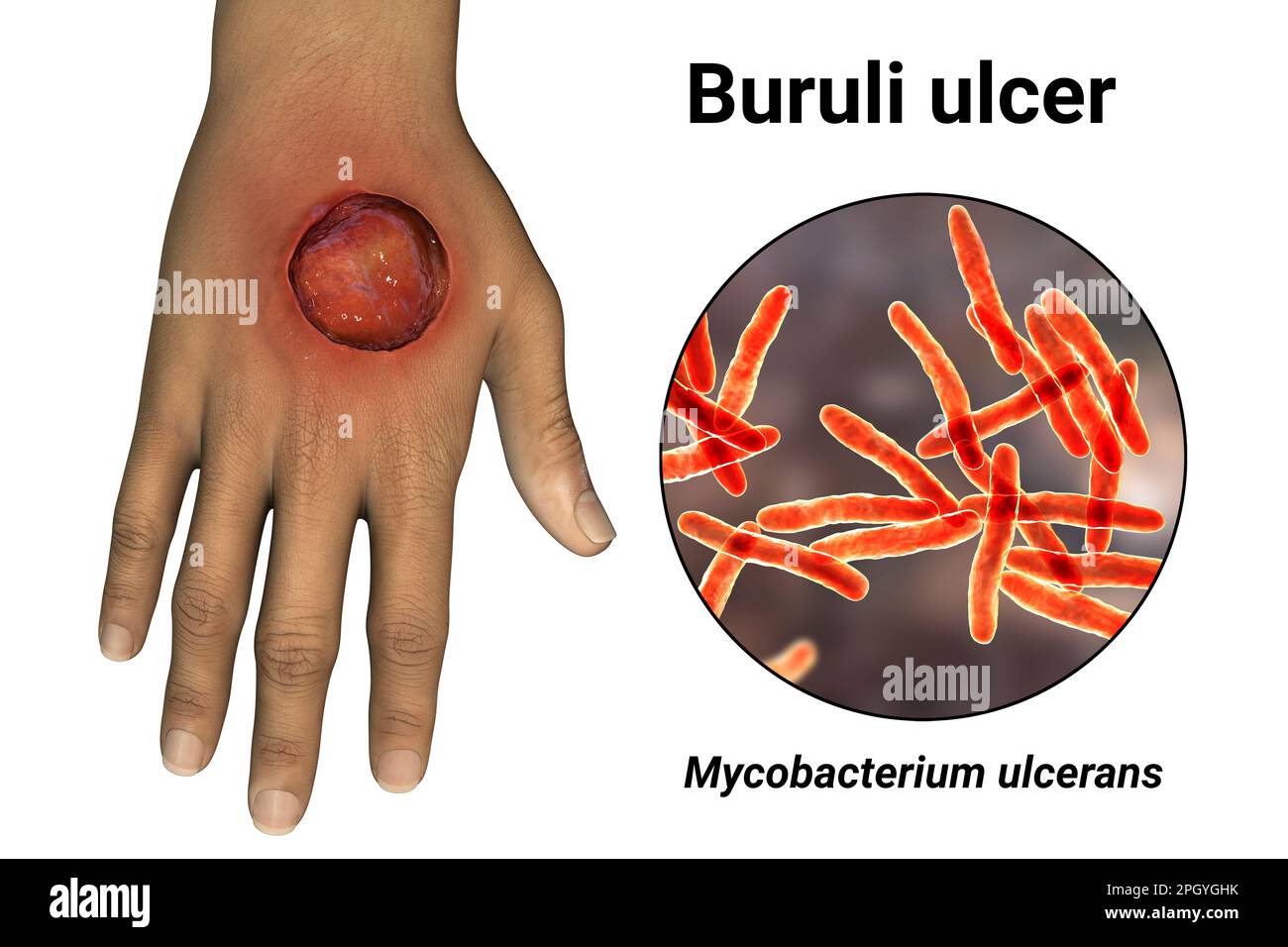 Buruli hi-res stock photography and images - Alamy