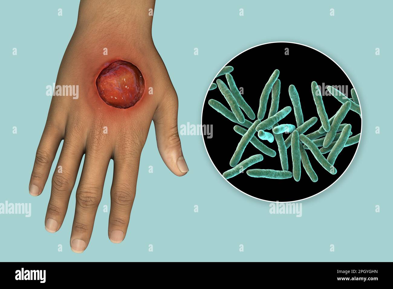 Buruli ulcer and Mycobacterium ulcerans, illustration Stock Photo - Alamy