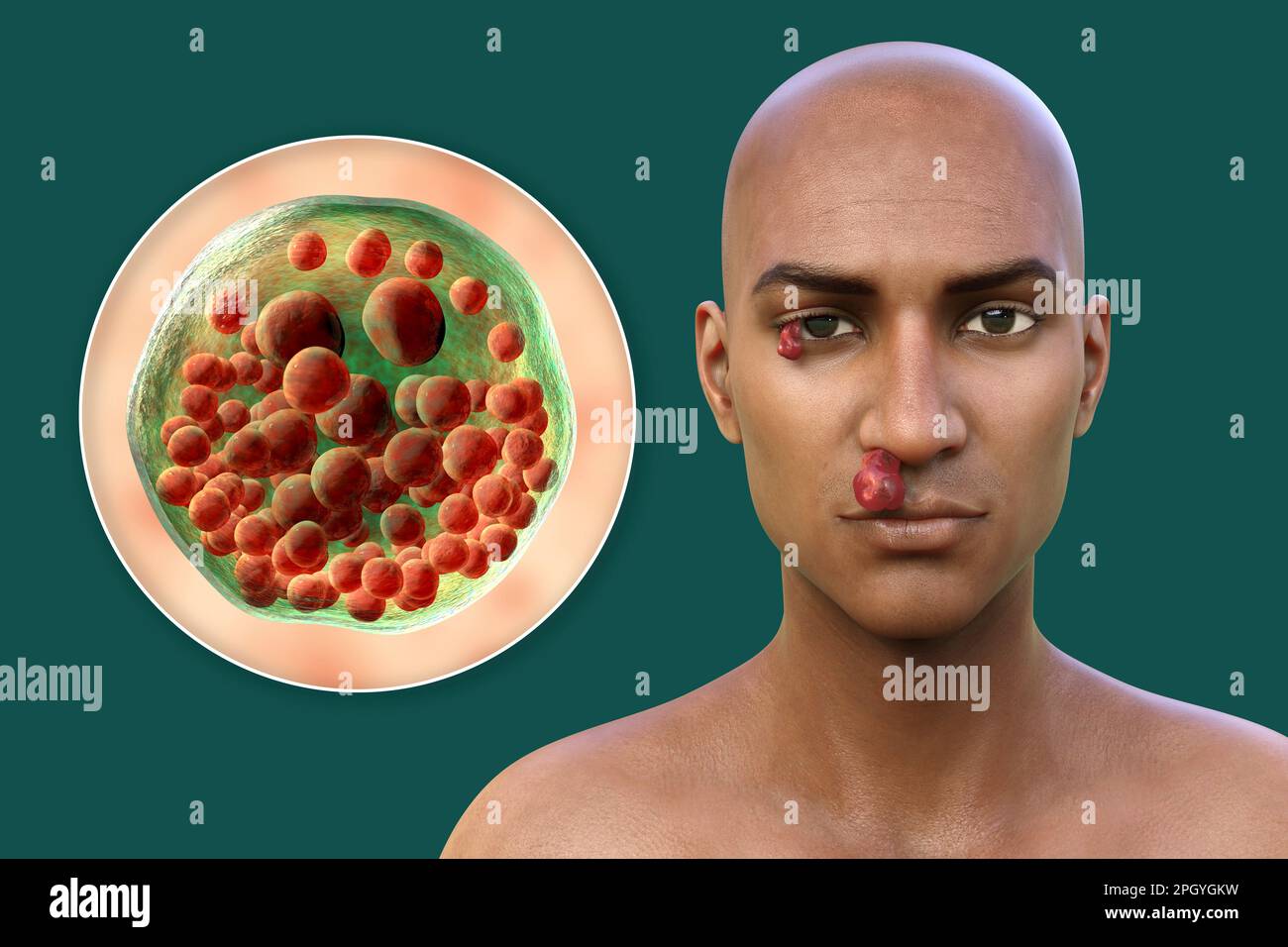 Nasal and ocular rhinosporidiosis, illustration Stock Photo - Alamy