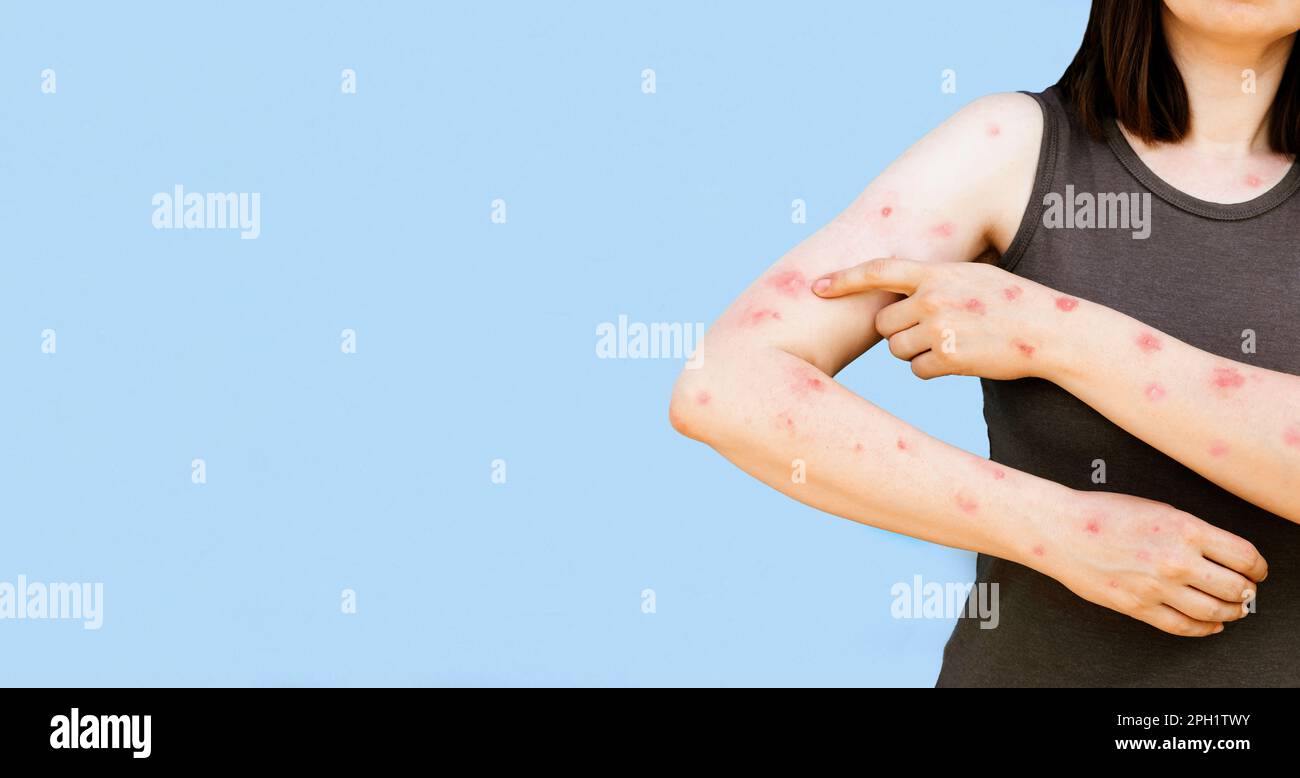 Monkeypox new disease dangerous over the world. Patient with Monkey Pox ...