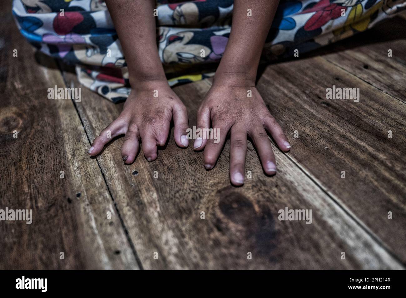 Reportage about minamata disease hi-res stock photography and images ...