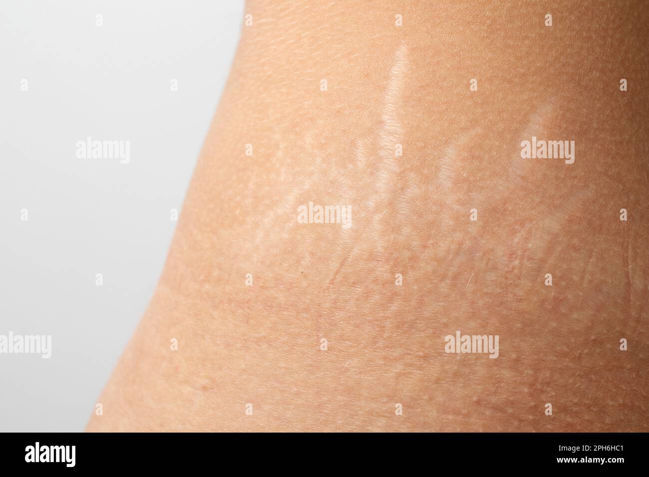 Stretch marks on the body skin of female thighs Stock Photo - Alamy