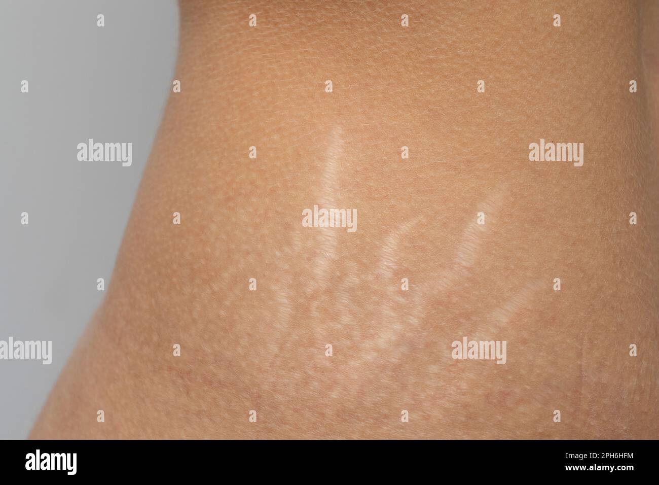 Stretch marks on the body skin of female hips Stock Photo - Alamy