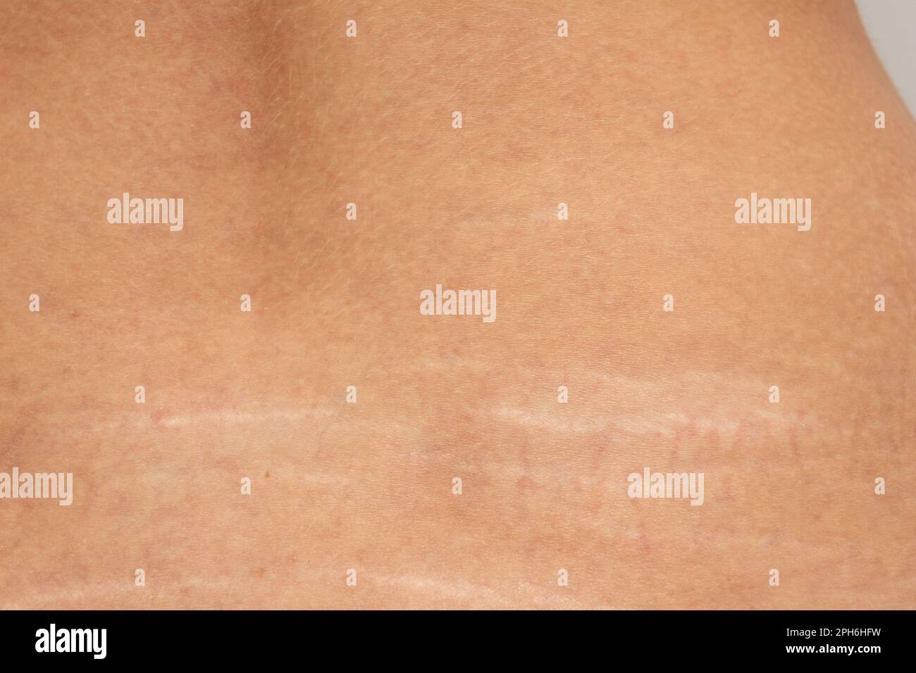 Stretch marks on the lower back Stock Photo - Alamy