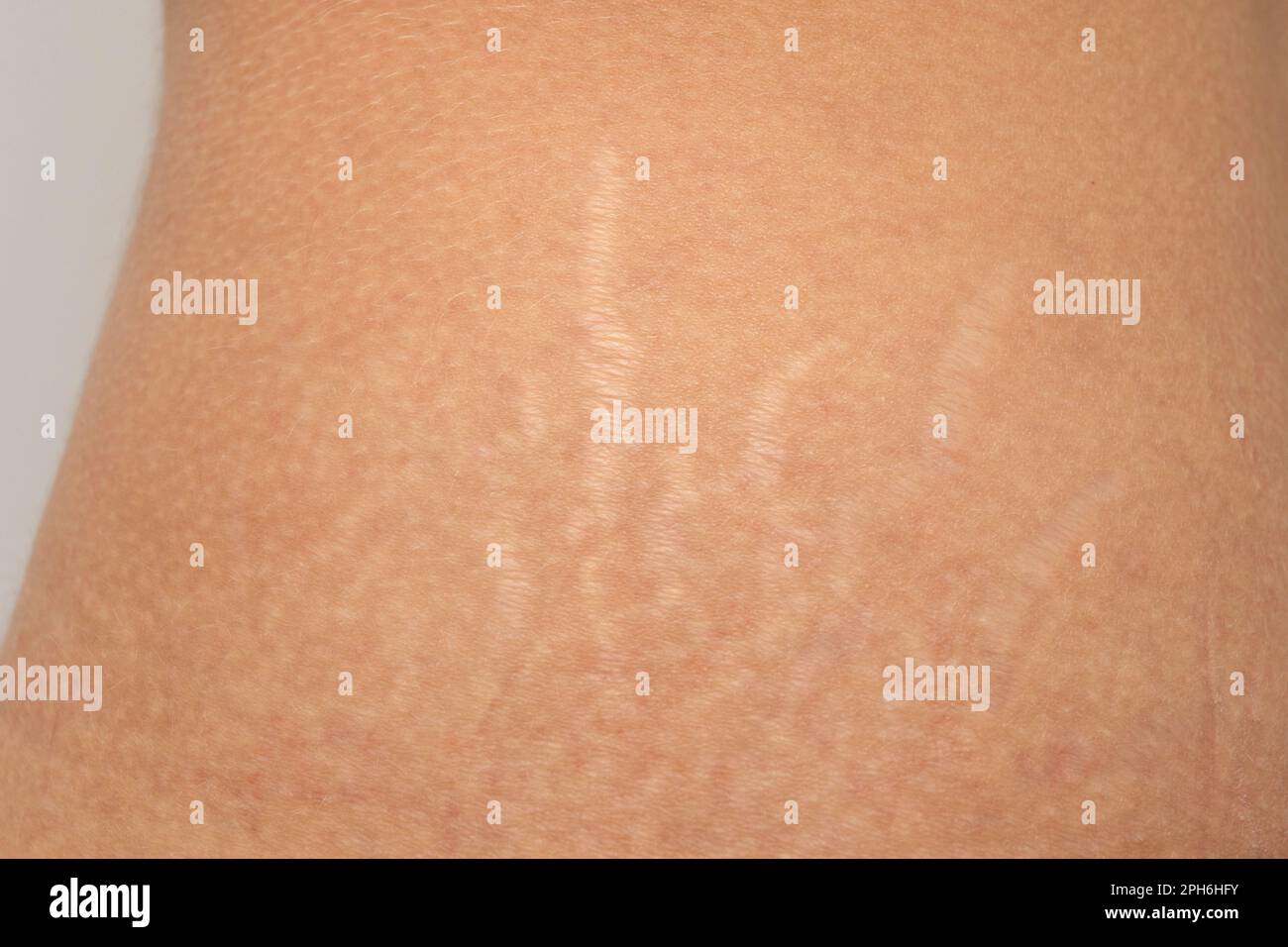 Stretch marks on the body skin of female thighs Stock Photo - Alamy