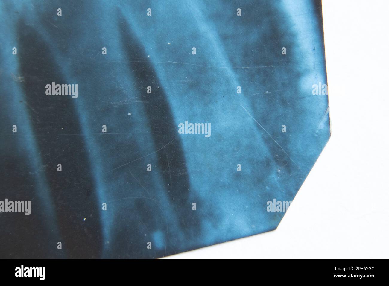 X-ray of an elderly person with osteoporosis and arthritis arthrosis ...