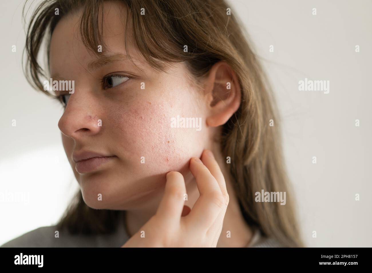 Problem skin face. A teenage girl with a troubled face Stock Photo - Alamy