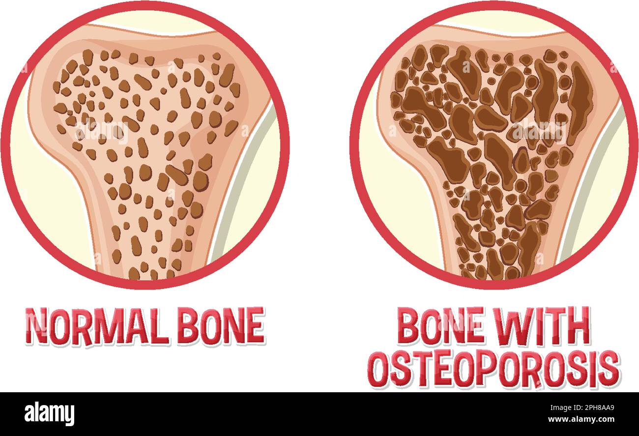 Comparison of normal bone and bone with Osteoporosis illustration Stock ...