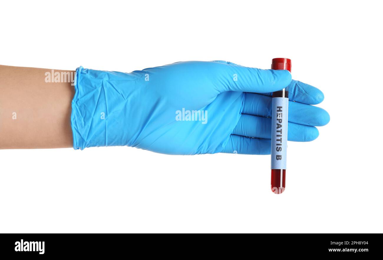 Scientist holding tube with blood sample and label Hepatitis B on white ...