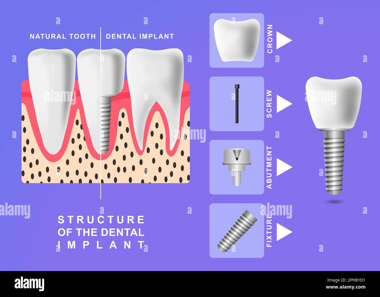 Structure of dental implant on violet background, illustration ...