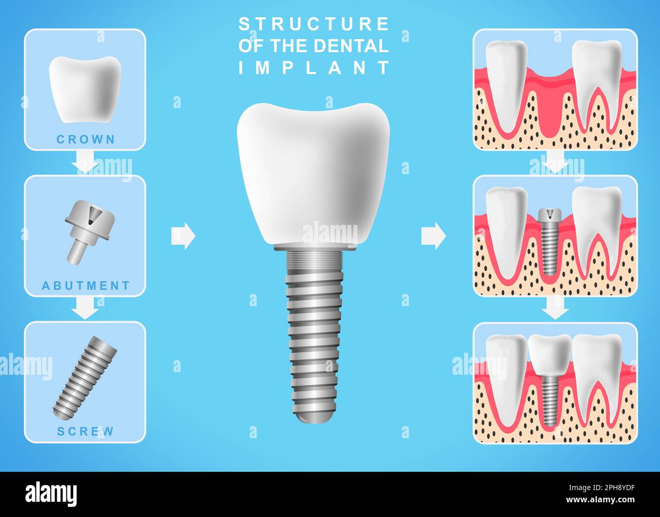 Structure of dental implant on light blue background, illustration ...