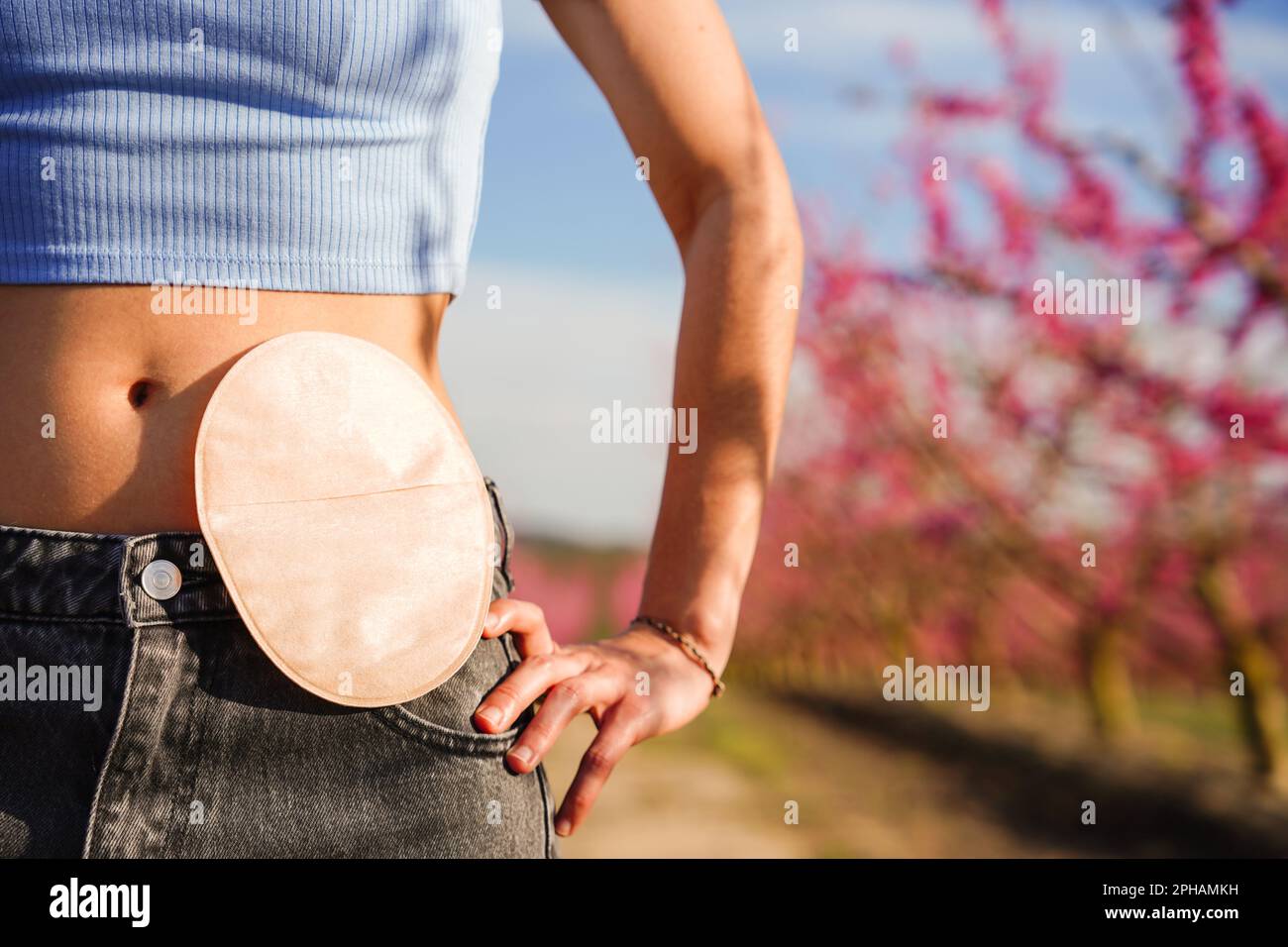 woman in a field of pink flowers with an ostomy bag in spring. colon ...