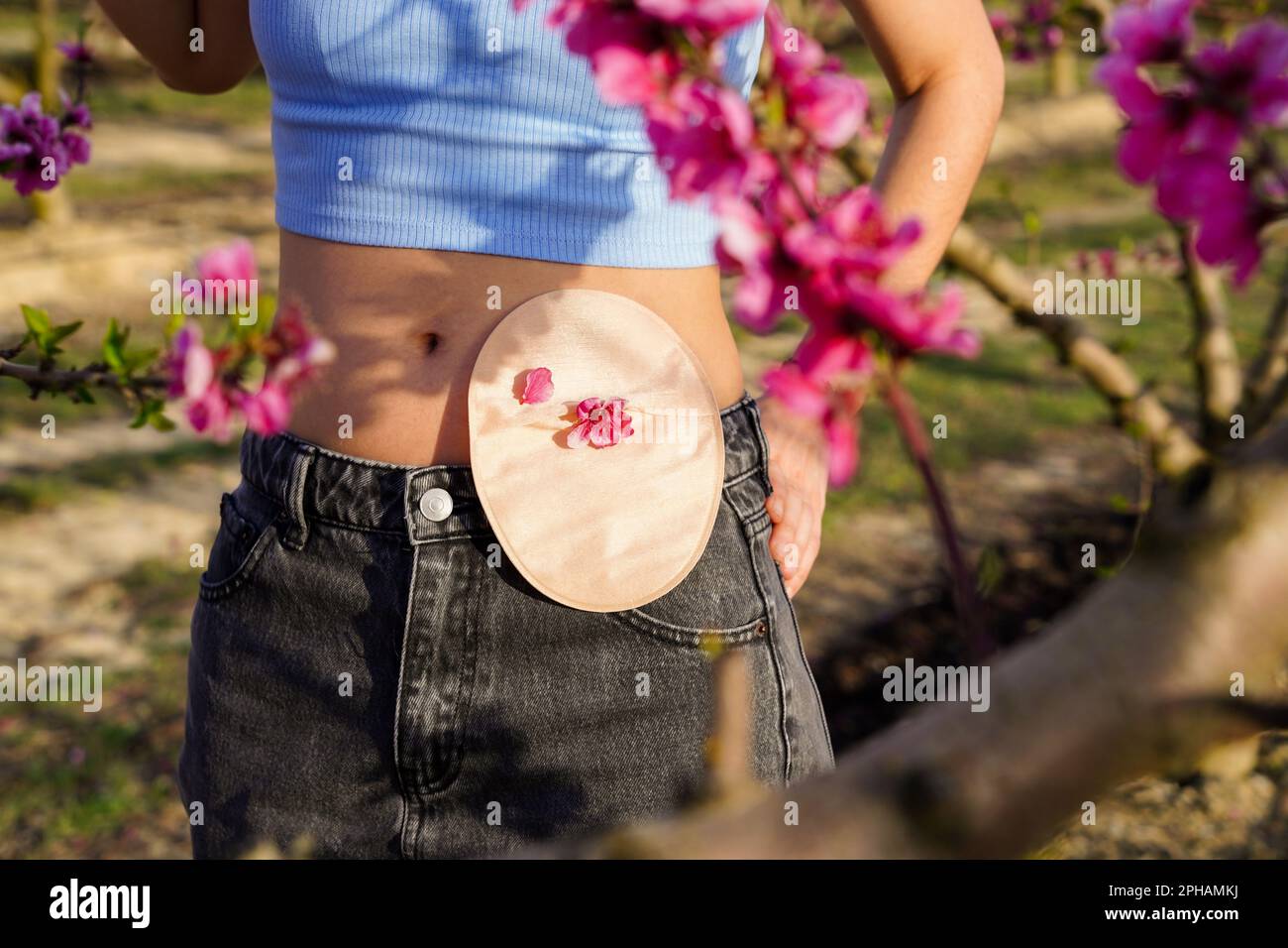 Ostomized hi-res stock photography and images - Alamy