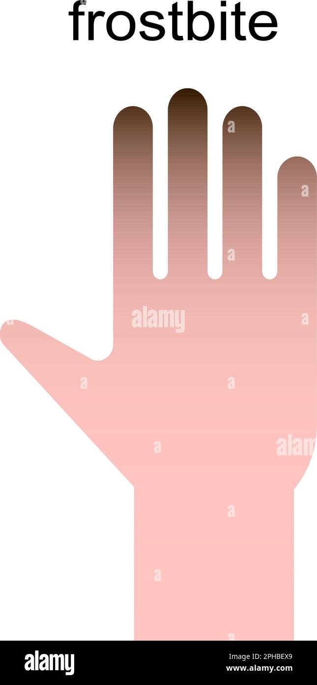 Frozen hand with fingers vector illustration. Medical frostbite. Skin ...