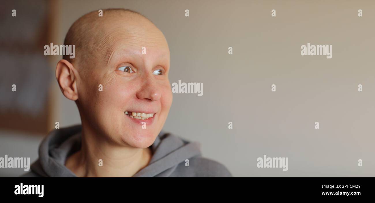 Effects of chemotherapy. Portrait of funny face millennial hairless ...
