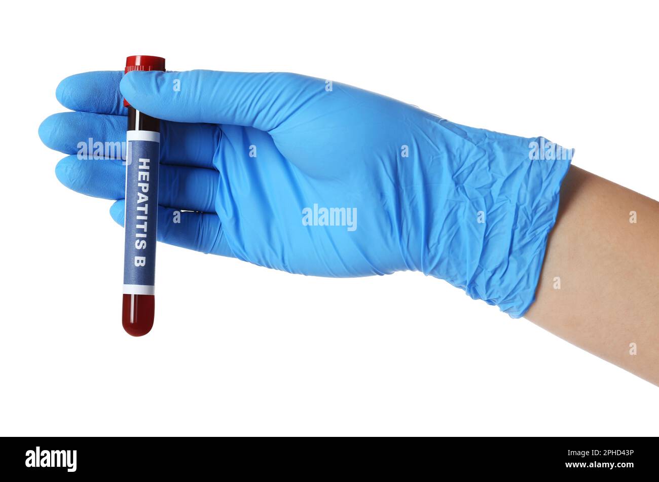 Scientist holding tube with blood sample and label Hepatitis B on white ...