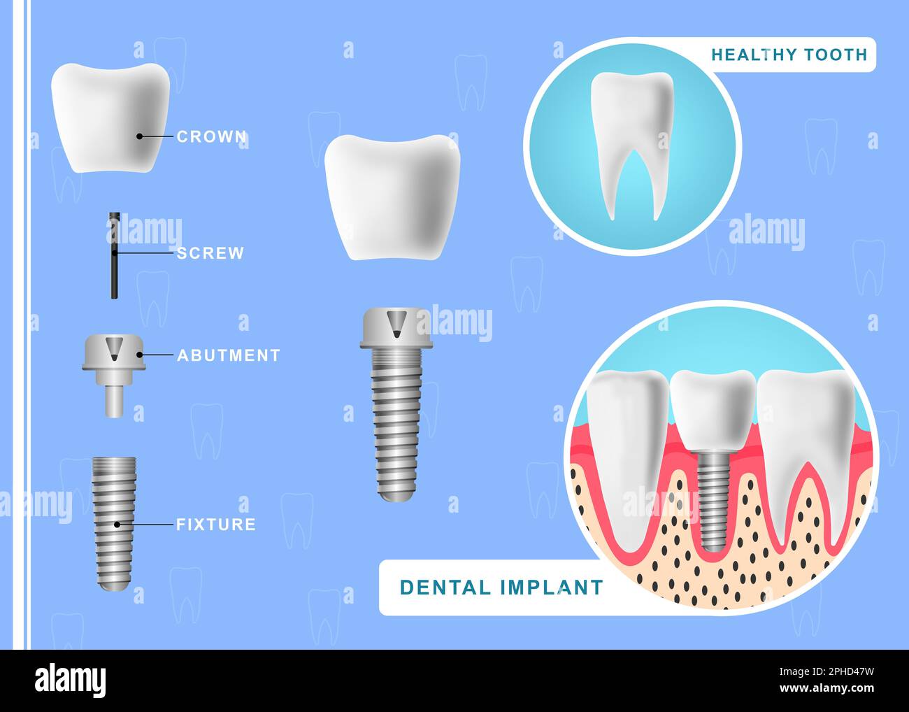 Structure of dental implant on light blue background, illustration ...