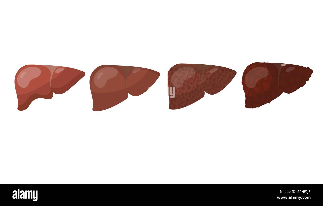 Stages of human liver destruction cartoon illustration set Stock Vector ...