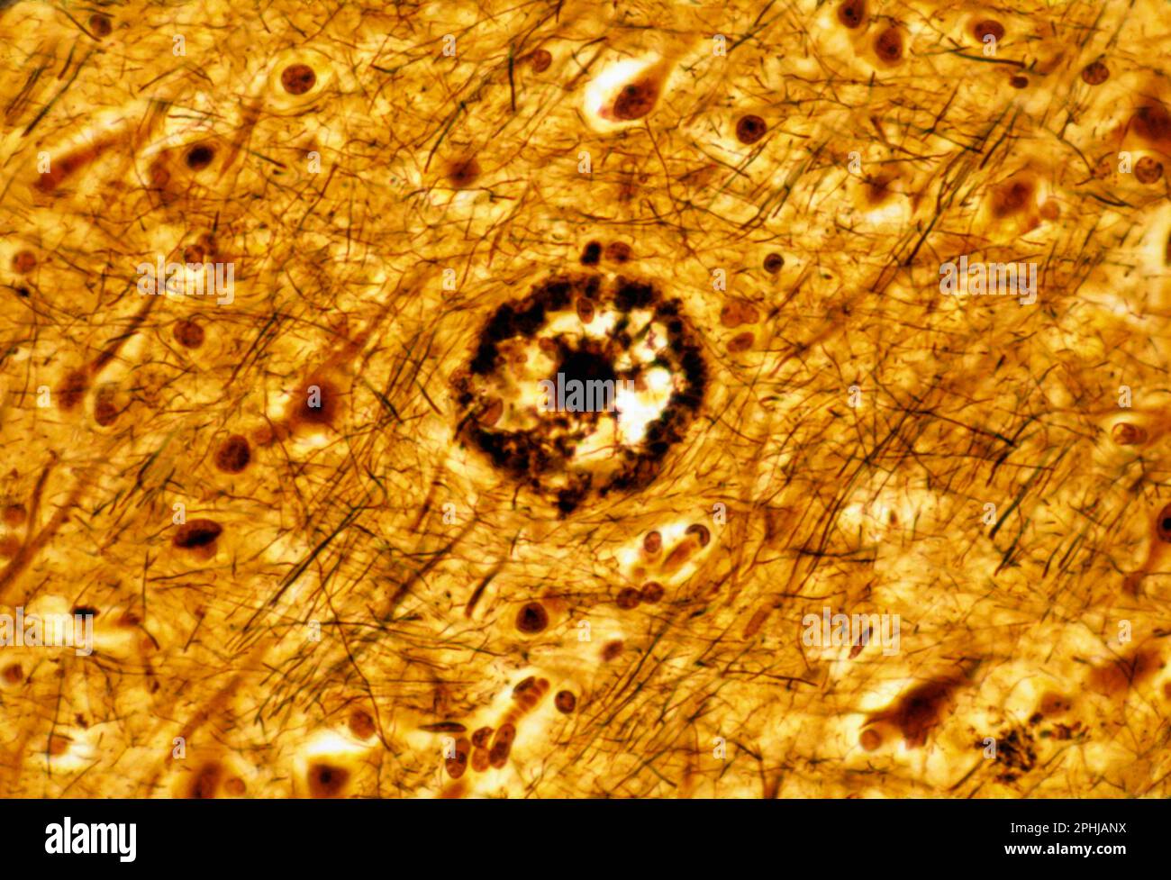 Senile plaque in cerebral cortex, light micrograph Stock Photo - Alamy