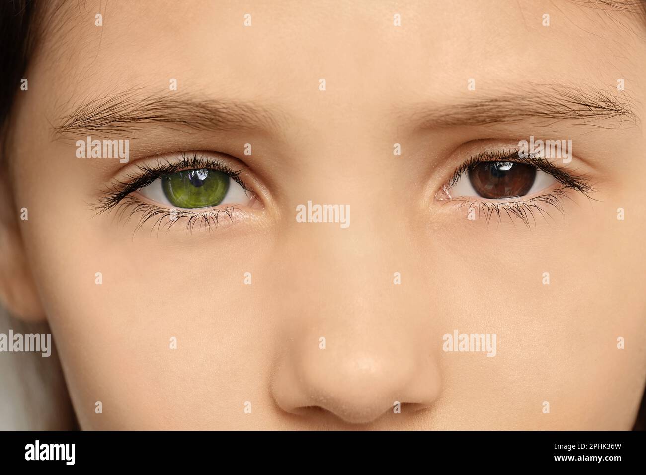 Little girl with different colors of eyes, closeup. Heterochromia ...