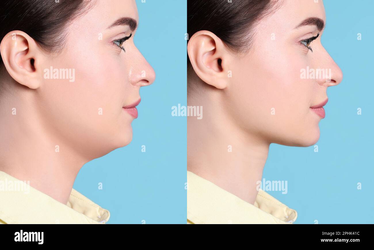 Double chin problem. Collage with photos of young woman before and ...