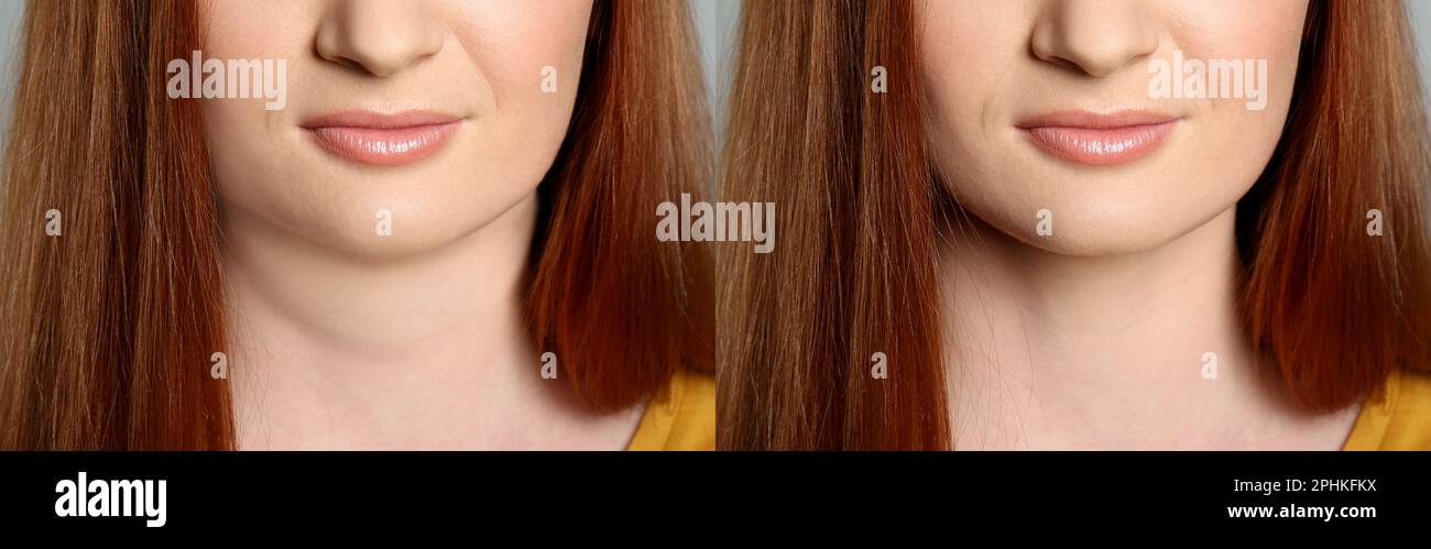 Double chin problem. Collage with photos of young woman before and ...