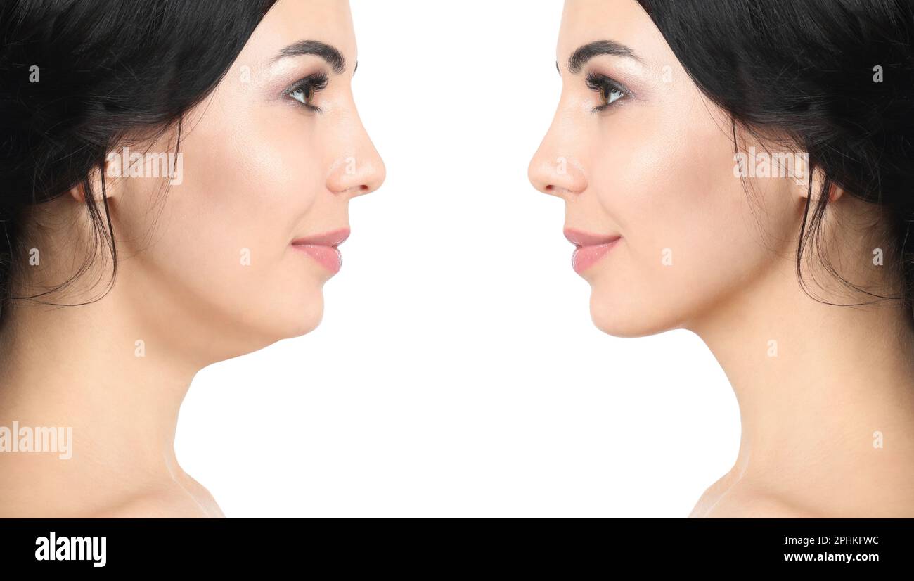 Double chin problem. Collage with photos of young woman before and ...