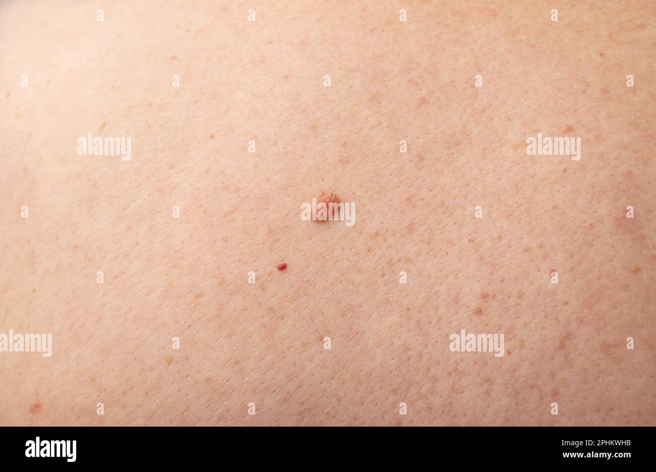Malignant melanoma skin hi-res stock photography and images - Alamy