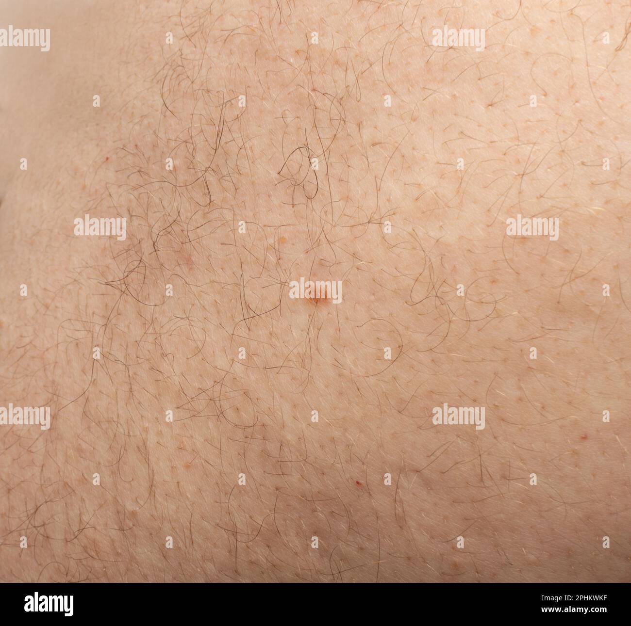 Skin mole closeup. Macro photo of blemish similar to melanoma, brown ...
