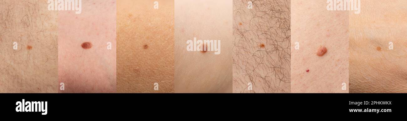 Different types of skin mole closeup. Macro photo of blemish classes ...