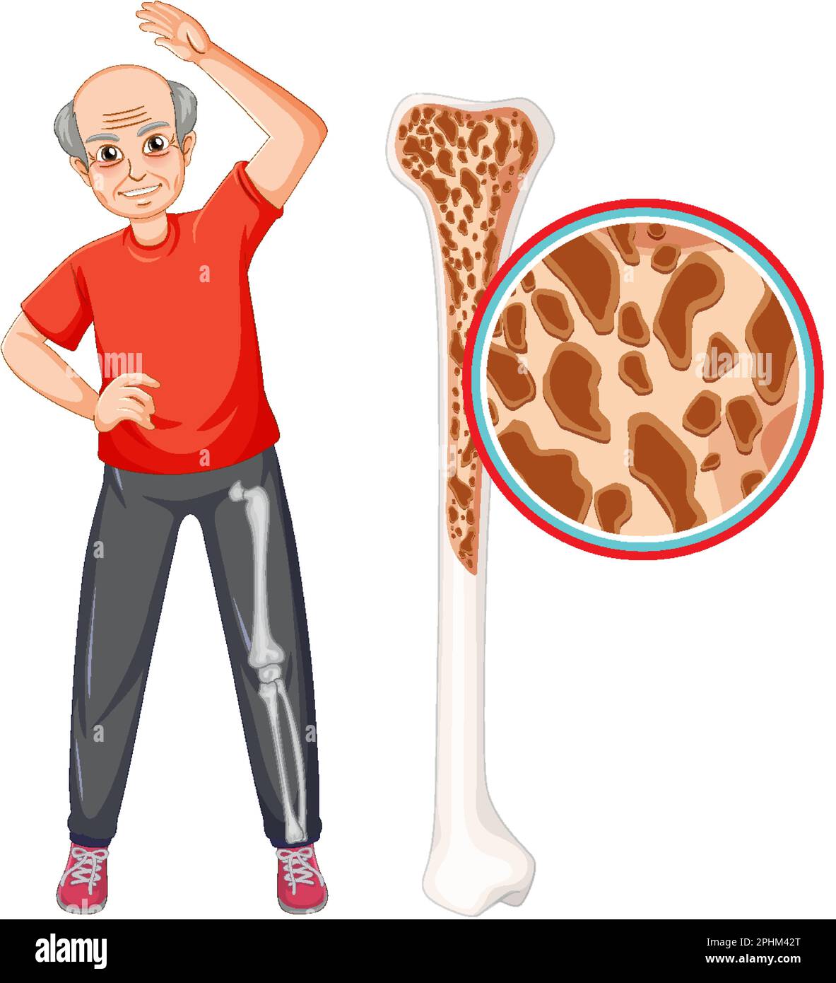 Osteoporosis in old people illustration Stock Vector Image & Art - Alamy