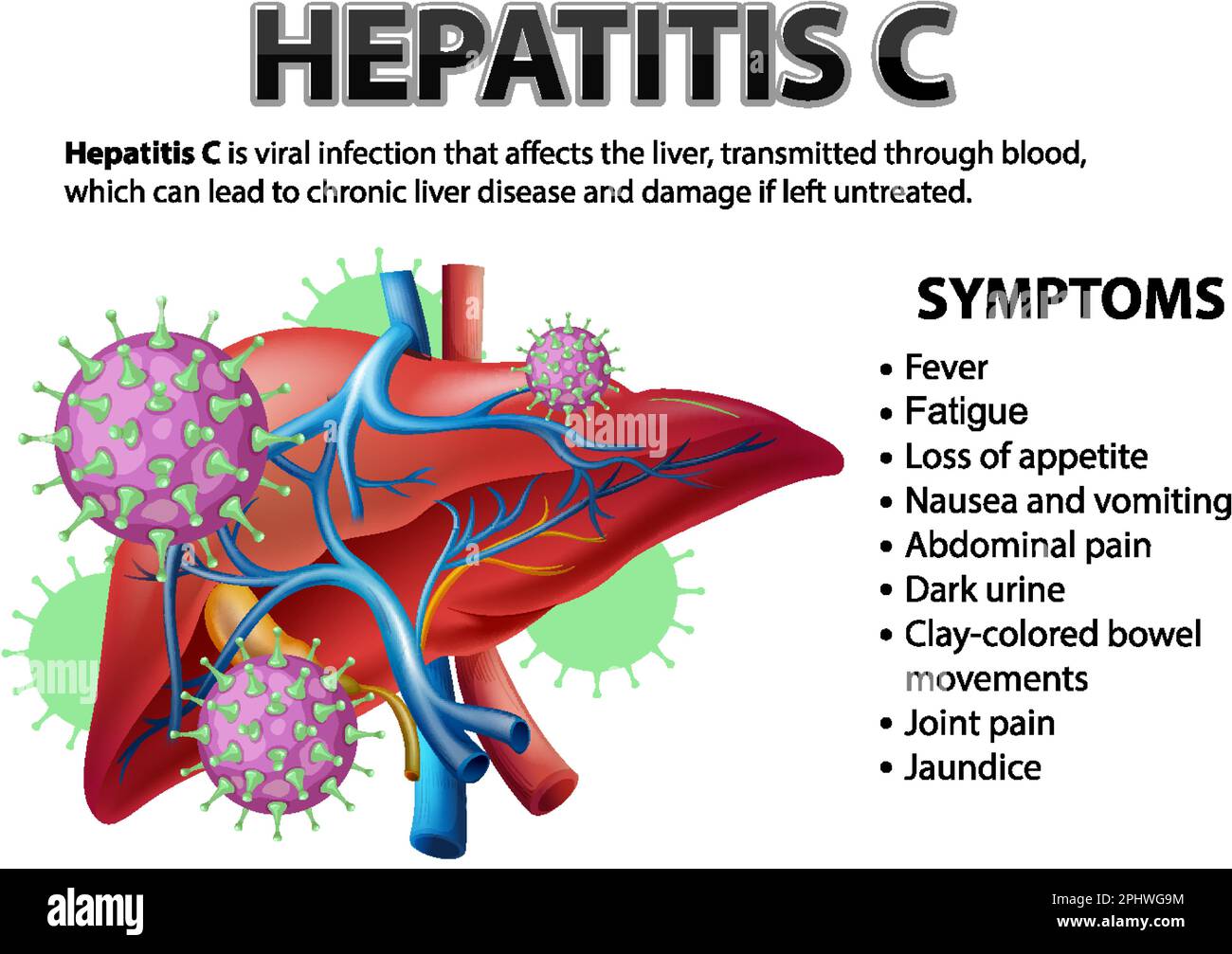 Explaining Hepatitis C with Vector Graphics illustration Stock Vector Image & Art - Alamy