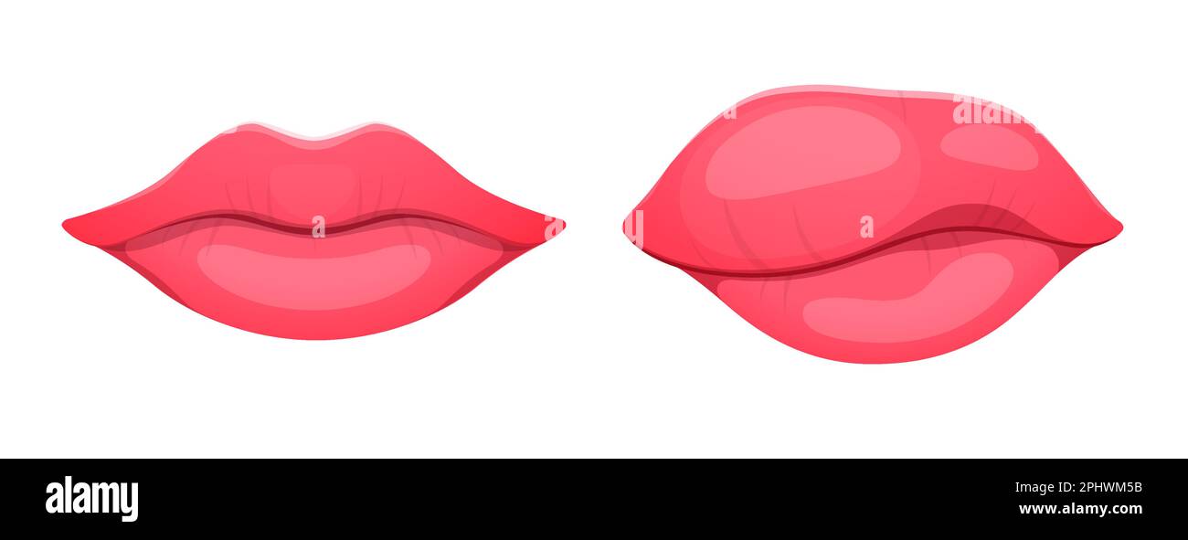 Angioedema or edema of lips. Body tissue swelling, allergic syndrome ...