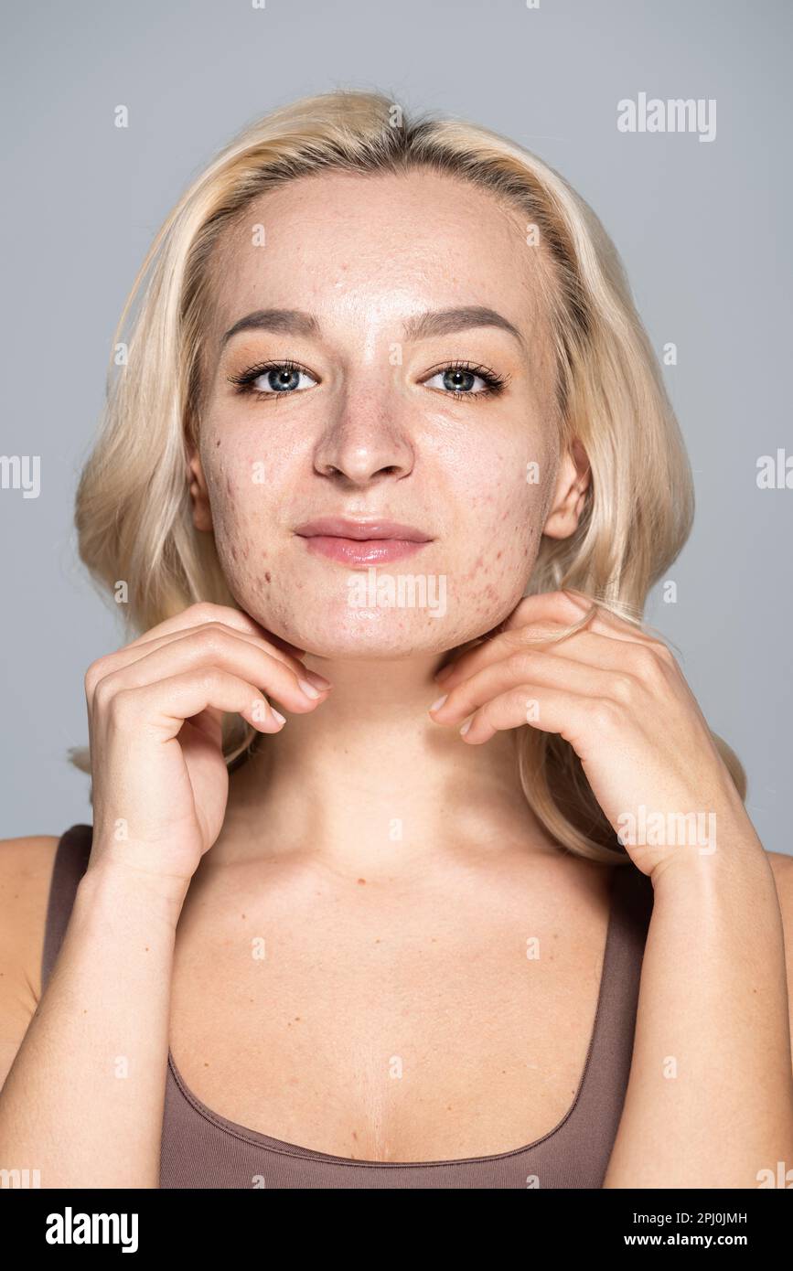 Portrait of blonde woman with skin issue on face isolated on grey,stock ...
