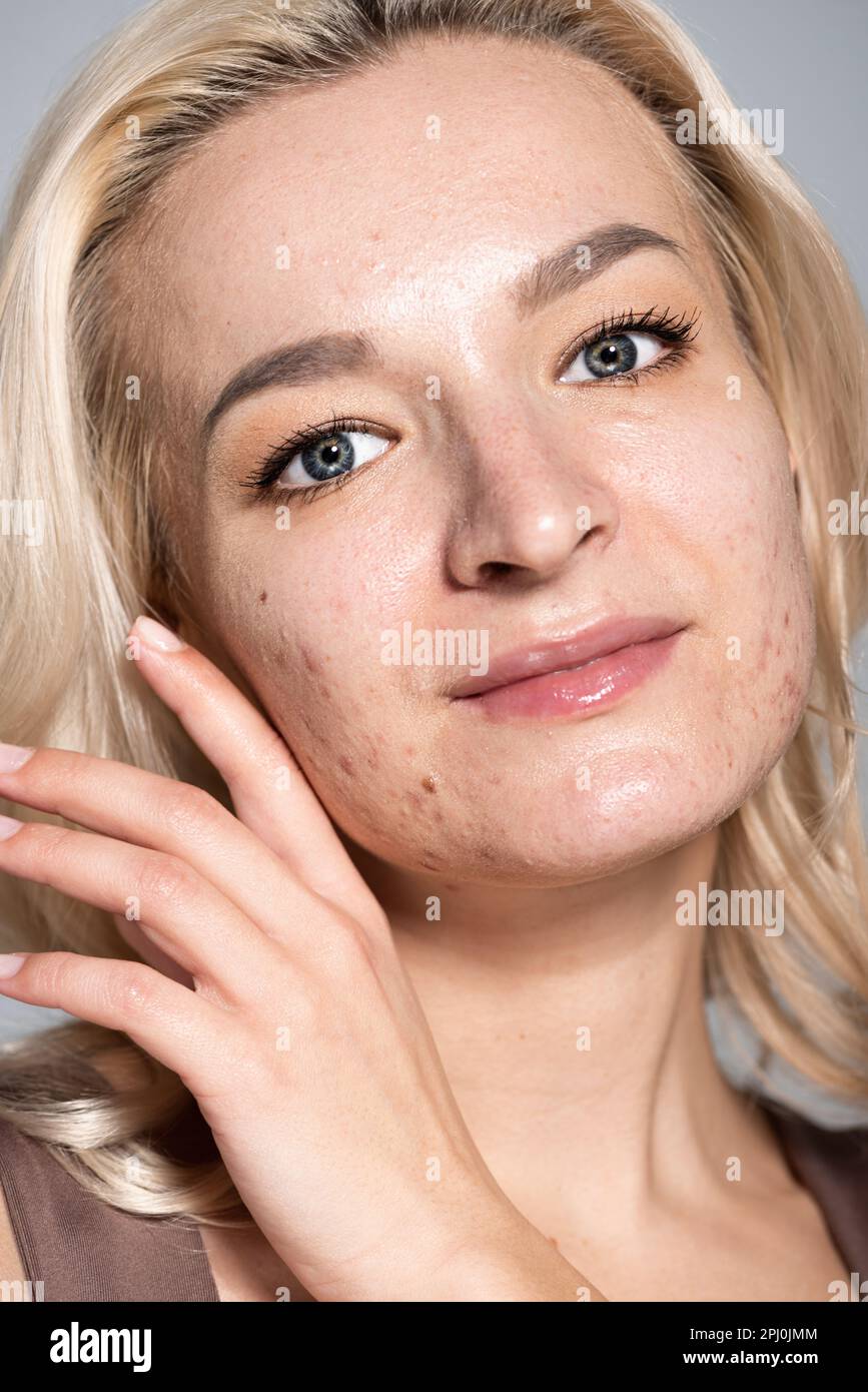 Close up view of blonde woman with acne on skin isolated on grey,stock ...