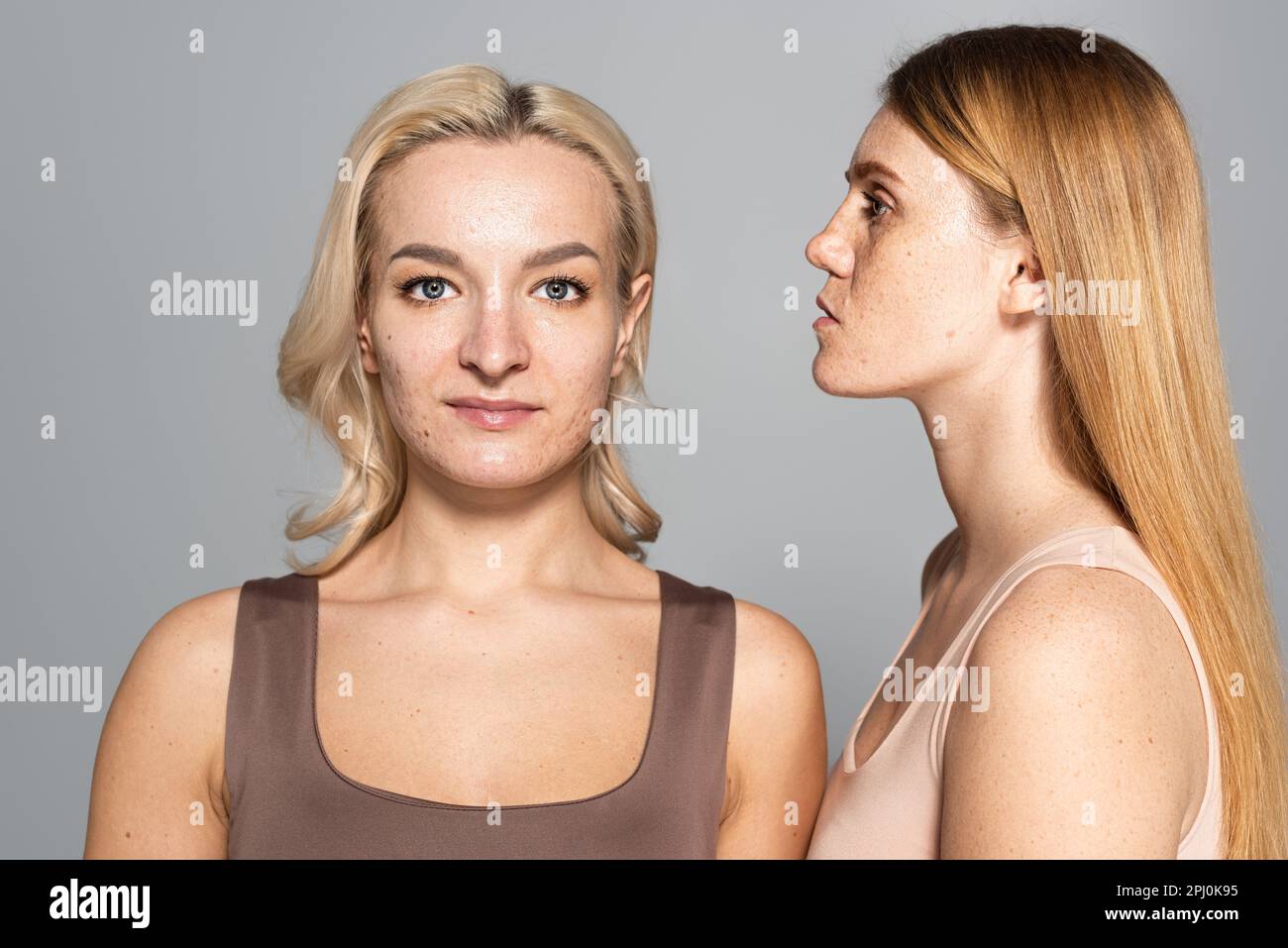 Portrait of women with acne and freckles on skin isolated on grey,stock ...