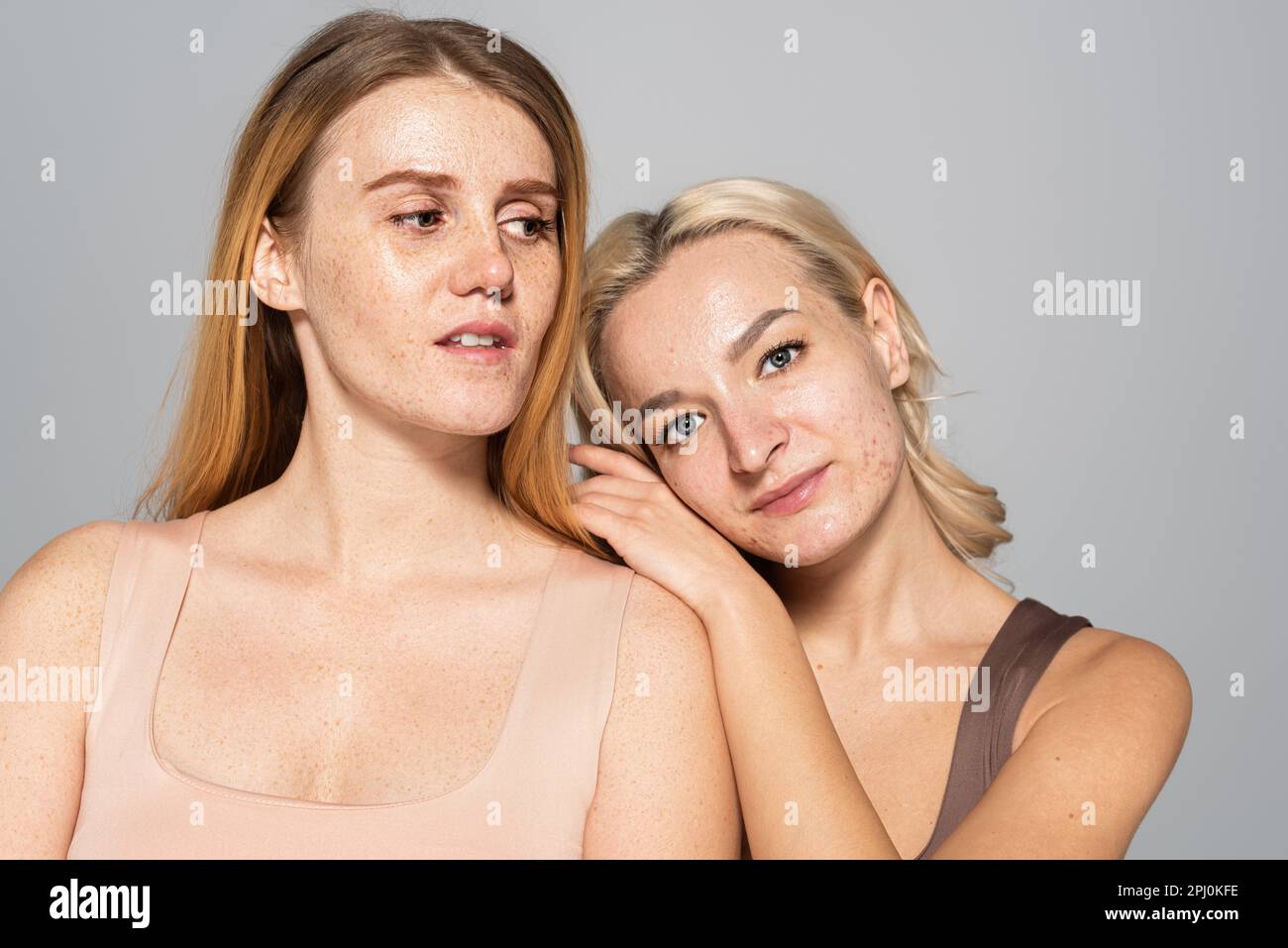 Freckled woman standing near friend with acne on face isolated on grey ...