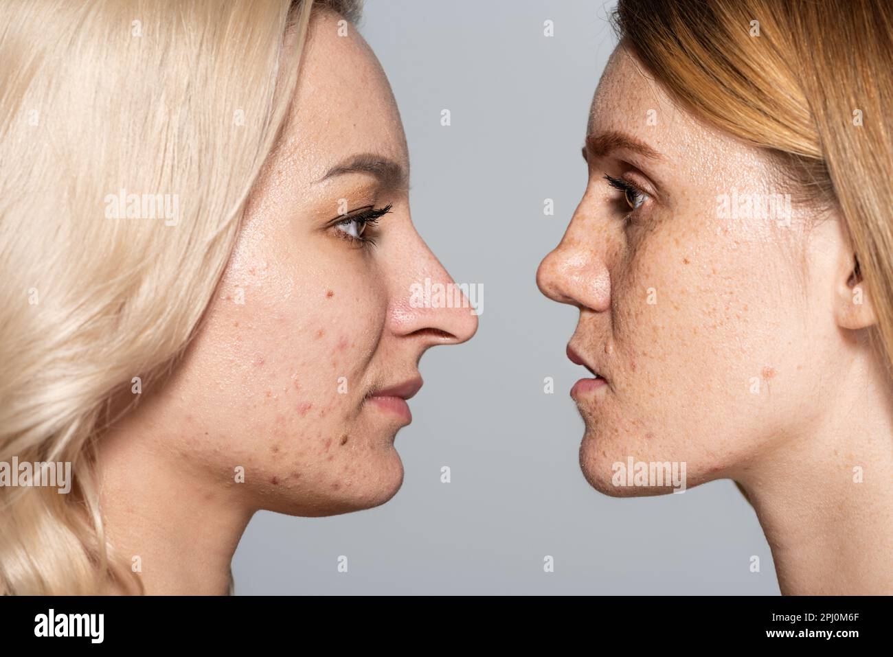 profile of women with problem skin standing face to face isolated on ...