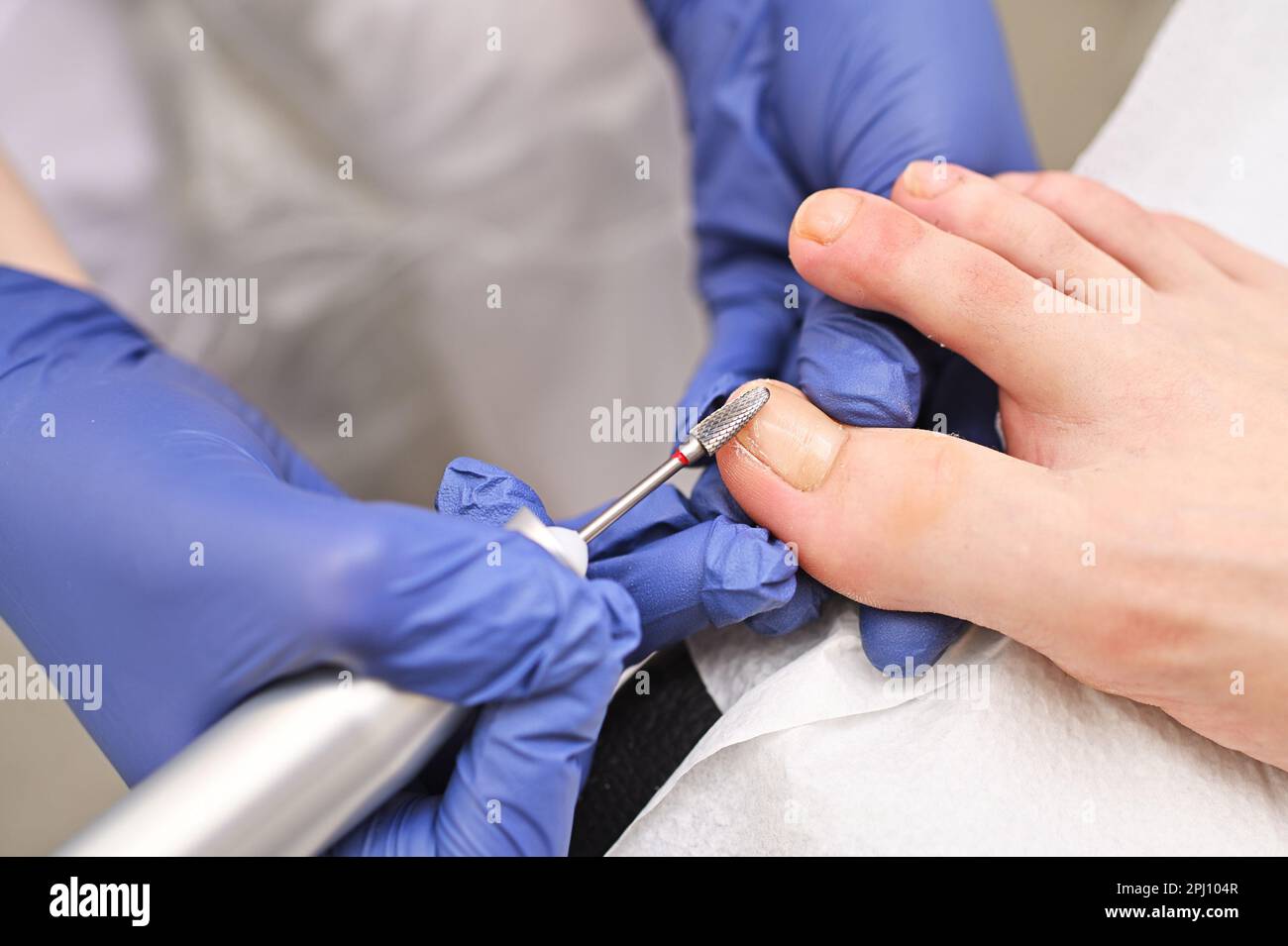 Hardware medical pedicure with a drill and nail files. A patient on a ...