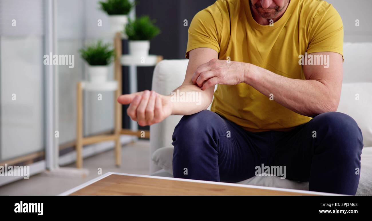 Man With Itchy Skin. Allergy Or Psoriasis Stock Photo - Alamy