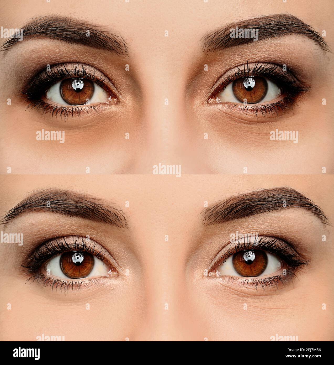 Collage with photos of tired woman with dark circle under eye and after ...