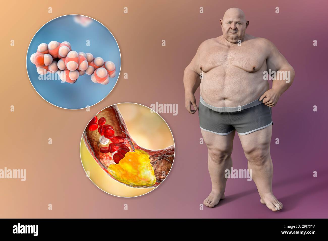 Obesity and atherosclerosis, conceptual illustration Stock Photo - Alamy Obesity and atherosclerosis, conceptual illustration Stock Photo - Alamy