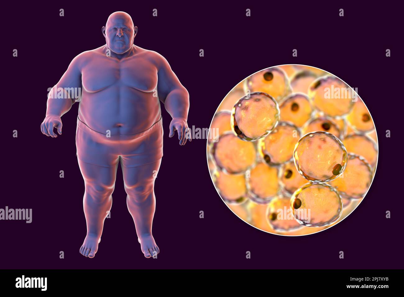 Obese man and fat cells, illustration Stock Photo - Alamy