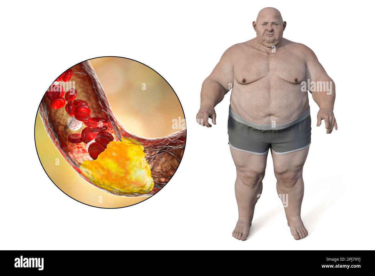 Obesity and atherosclerosis, conceptual illustration Stock Photo - Alamy Obesity and atherosclerosis, conceptual illustration Stock Photo - Alamy