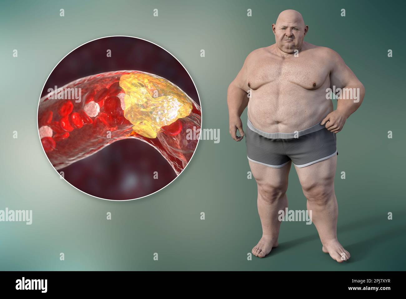 Obesity and atherosclerosis, conceptual illustration Stock Photo - Alamy Obesity and atherosclerosis, conceptual illustration Stock Photo - Alamy