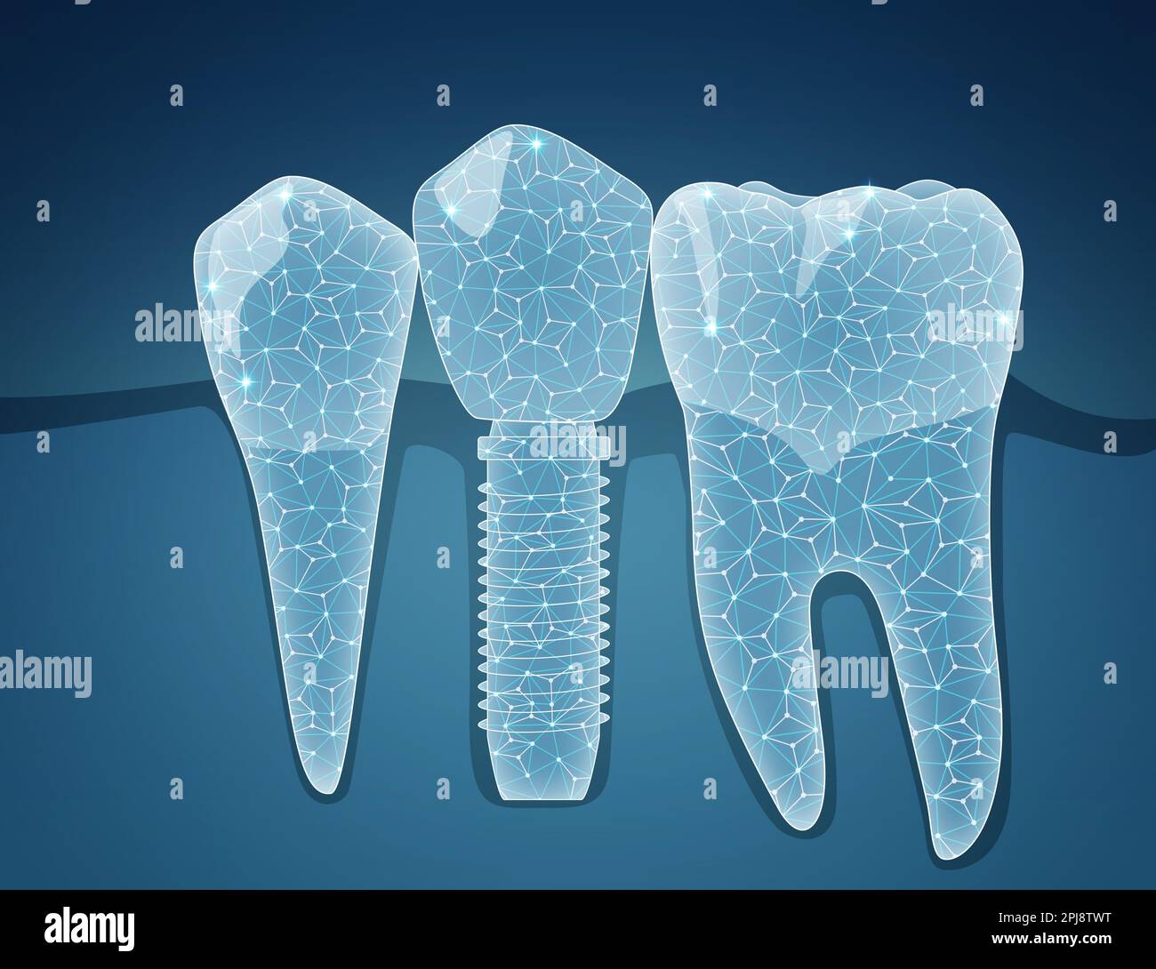 Illustration of teeth and dental implant on blue background Stock Photo ...