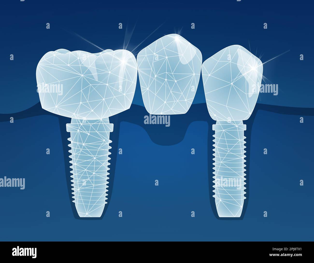 Illustration of tooth and dental implants on blue background Stock ...