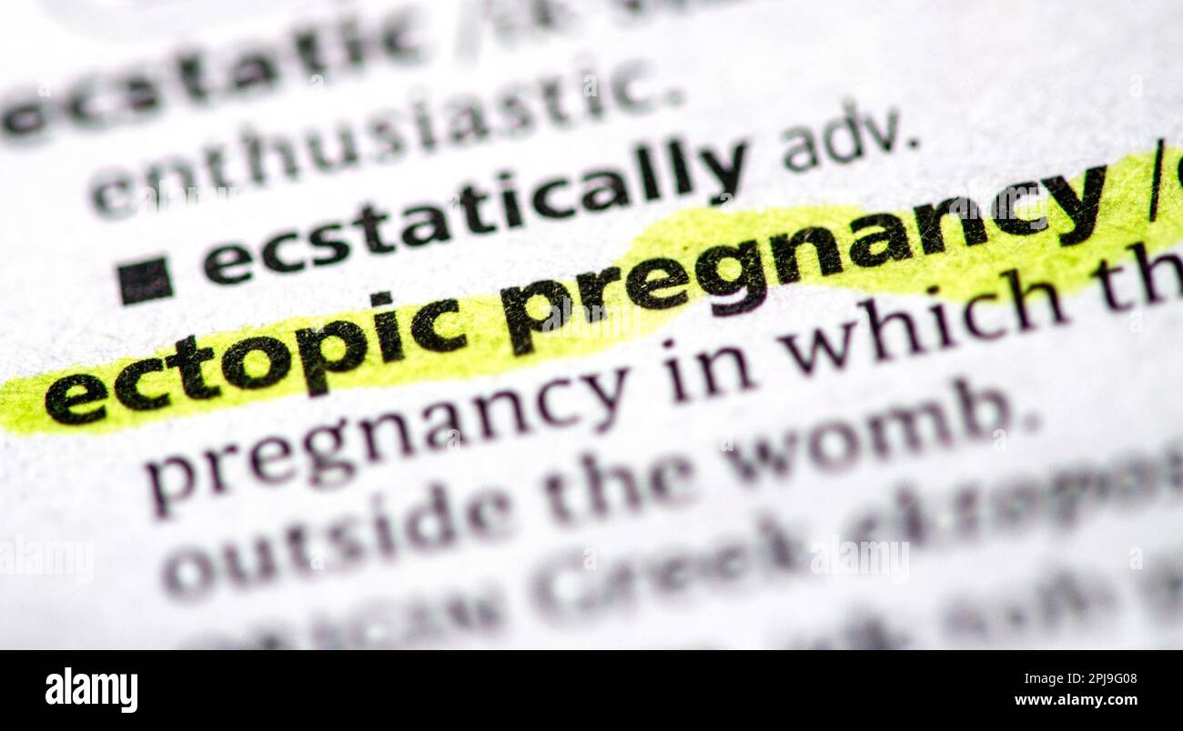 Ectopic pregnancy hi-res stock photography and images - Alamy