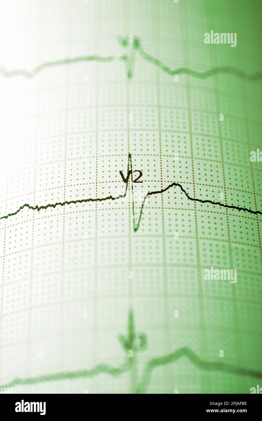 Electrocardiogram showing the pulse of the human heart Stock Photo - Alamy