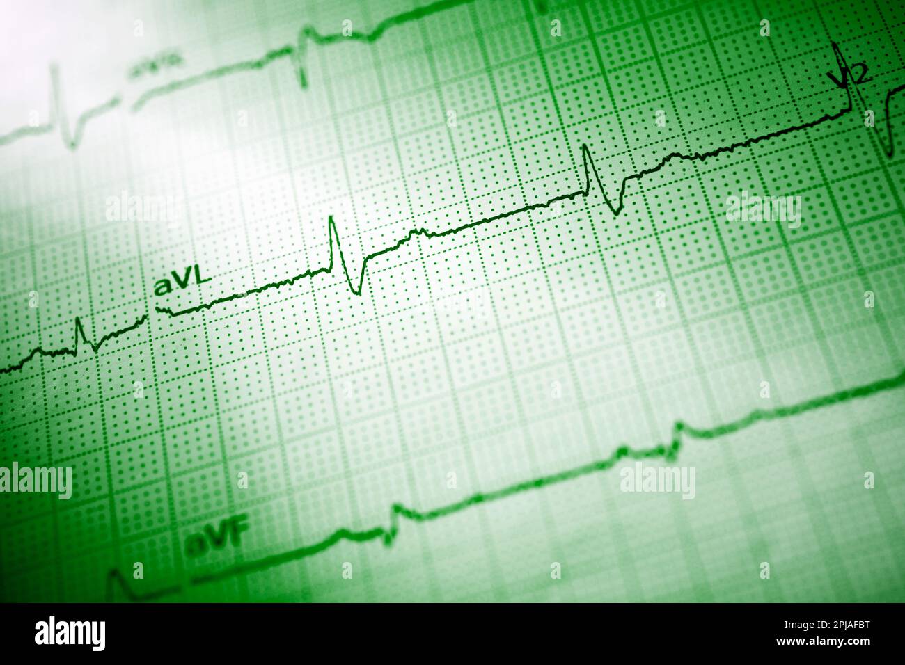 Electrocardiogram showing the pulse of the human heart Stock Photo - Alamy